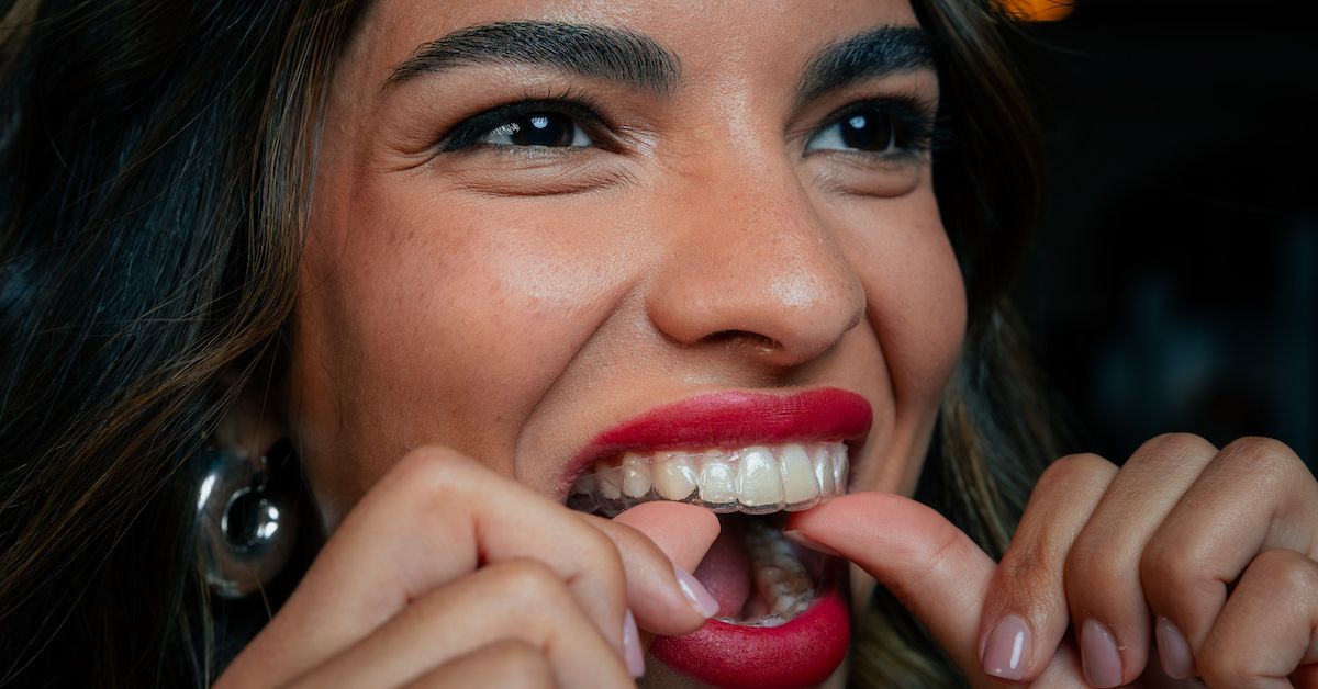 Retenedores dentales: qué son y para qué sirven 🦷