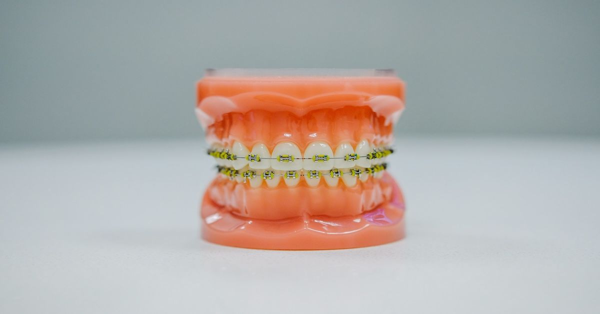 How to use orthodontic wax for braces and aligners 🦷