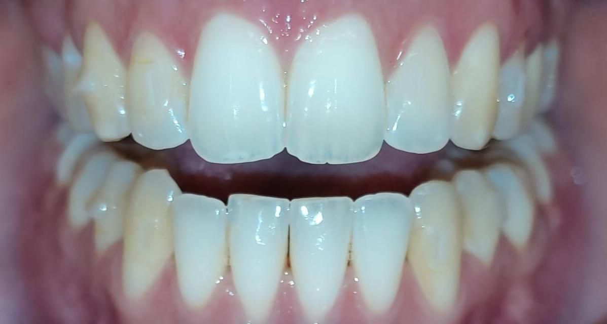 What Is An Open Bite Types Causes And How To Fix It What Is An Open Bite Types Causes And How To Fix It