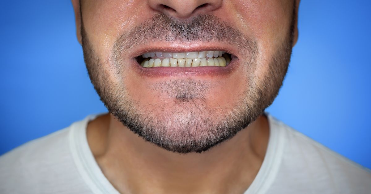 ¿Qué es la mordida cruzada anterior? 🦷