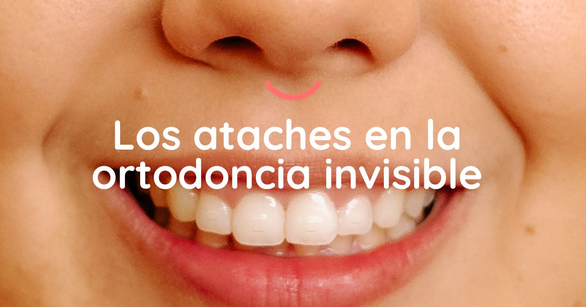 Ataches en ortodoncia invisible: qué son y para qué sirven 🦷