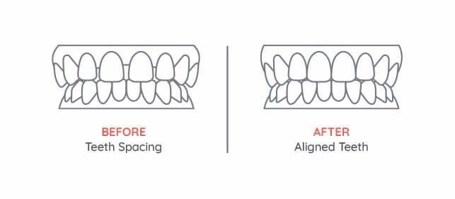 Before and After Invisible Orthodontics | Real Cases 🦷