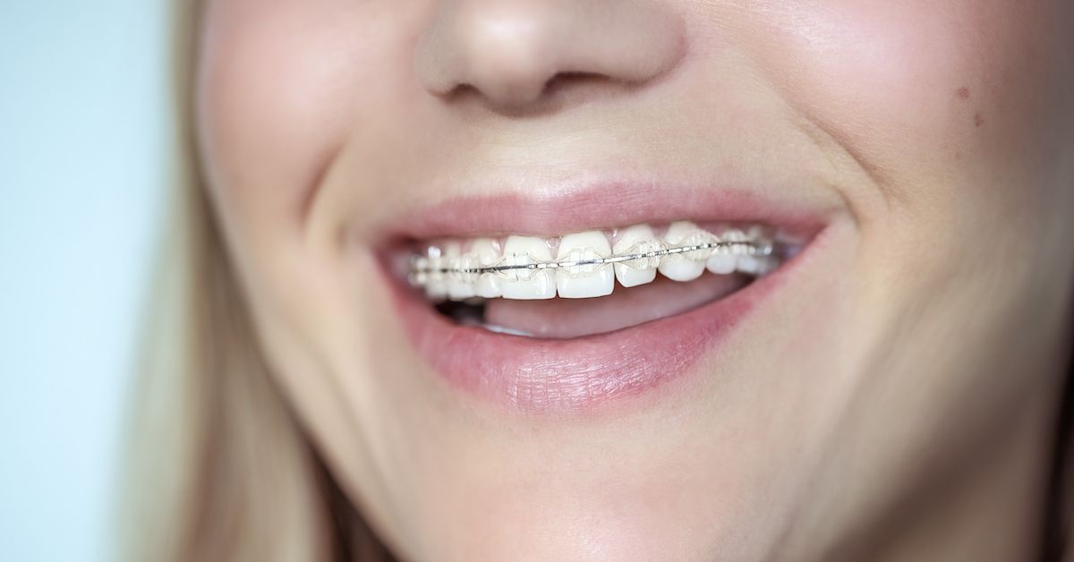 Brackets transparentes: conoce sus ventajas y desventajas 🦷
